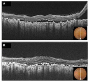 BDUMP：両眼性びまん性ぶどう膜メラノサイト増殖症 | めだまにあ